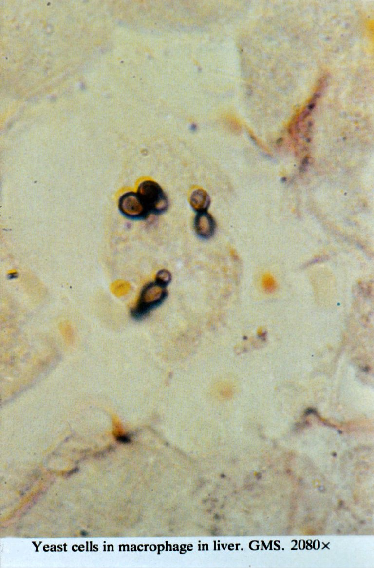 Histoplasmosis - Fungal Infection Trust